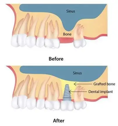 Sinus Lift in Irving | Kids & Grownups Dental